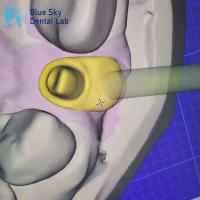 China Regular Implant Cases Customizable Single Implant Tooth  Offset Arch Implant Case for sale
