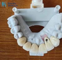China Highly Translucent Layered Zirconia Crowns Natural With Implant Crown for sale