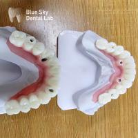 China Dental Multi Implant Cases Customized Implant Procedure Cases for sale