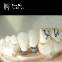 China Single Crowns Zirconia Abutment Hypoallergenic Dental Implant Zirconia Abutment for sale