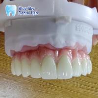 China Metal Frame Titanium Malo Bridge Customizable Malo Implant Bridge for sale