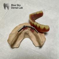 China Implant Overdenture Titanium Bar Dental Implant with removable denture for sale