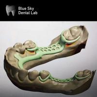 China Removable Partial Denture Metal Framework Partial Denture Framework Design for sale