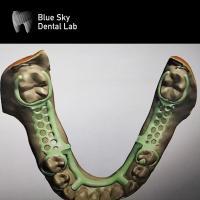 China Removable Partial Denture Metal Framework Partial Denture Framework Design for sale