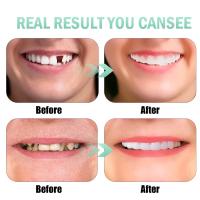 China SJ Smile Tooth Customizable Temporary Perfect Fake Teeth Molds Whitening Veneers Disposable Fake Braces for Teeth for sale