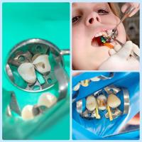 China SJ Dental instruments consumables disposable colorful fixing orthodontic dental wooden wedges for sale